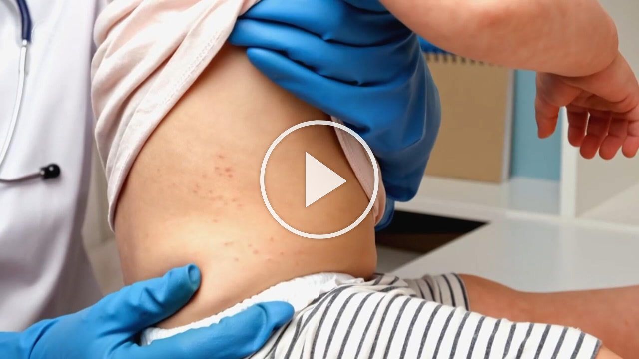 Declining vaccine rates fuel measles outbreak in South Carolina