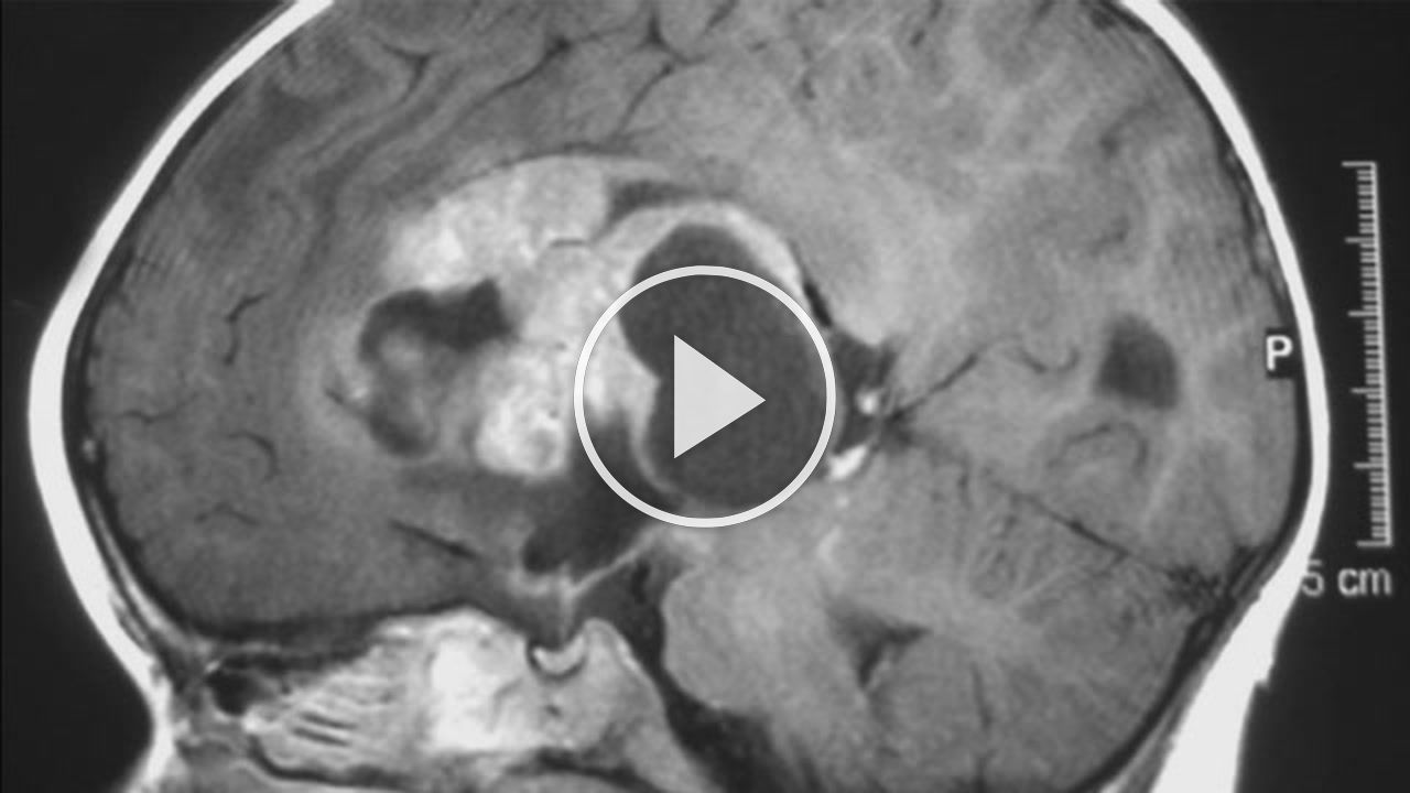 Synchron CEO explains the science behind their brain chip implants